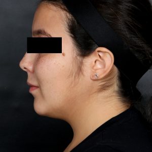 Lipopapada: Cuidados, beneficios y procedimiento